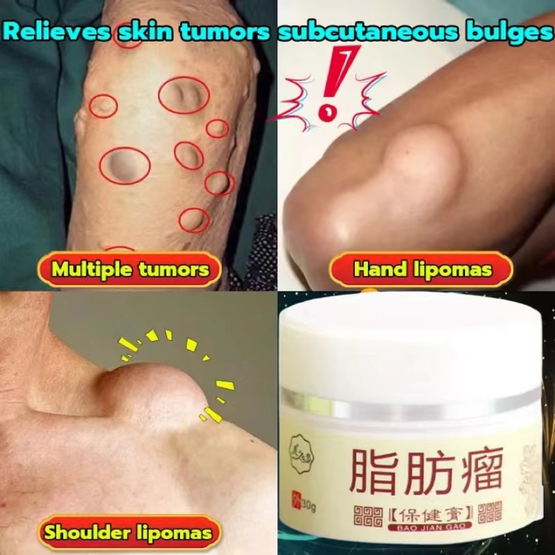 HCM30g Kem mềm u mỡ Lipoma Cream Subcutaneous Lump Removing Cream ...